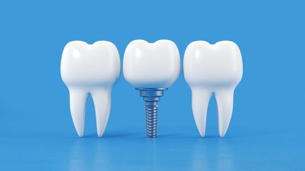 Dental Implants Melbourne - Missing Tooth Solutions